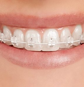 Best Orthodontist In Dubai | Klinica Dental Clinic