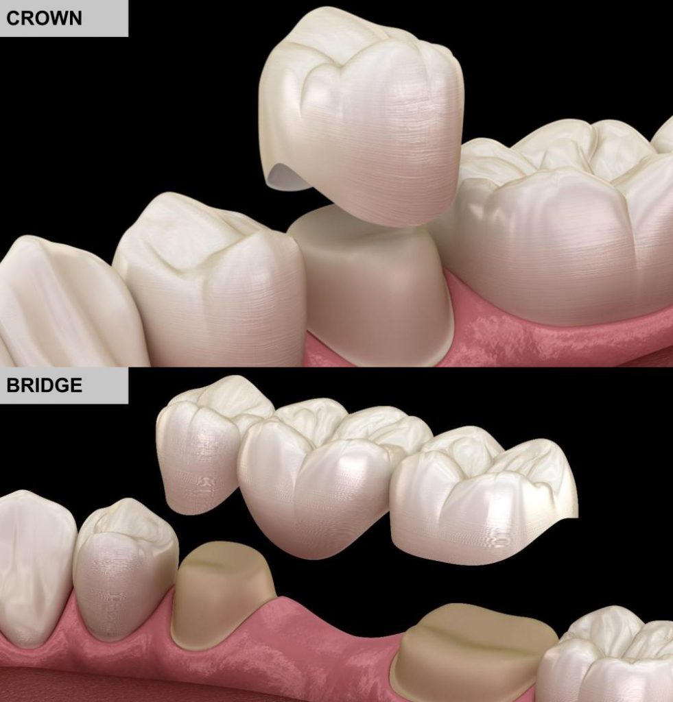 Prosthodontics | Get Dentures, Dental Crown At Affordable Cost In Al ...