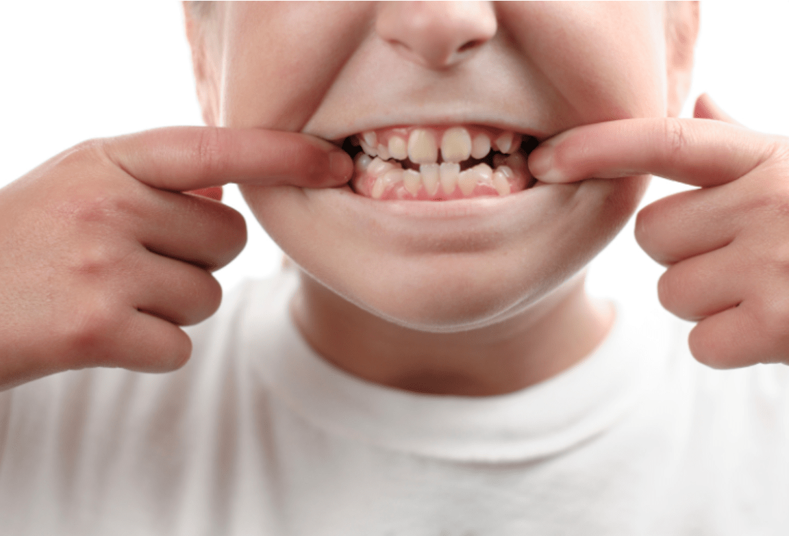 How to Improve Your Child’s Bite - Klinika Dental Clinic